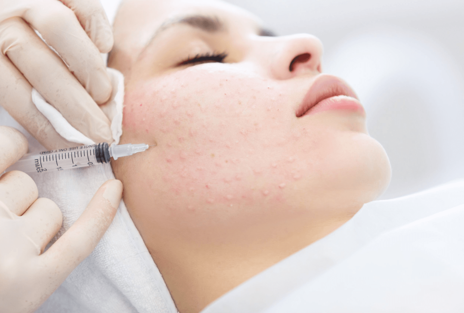 Meso Acne: Jenis Meso Treatment yang Dirancang Khusus untuk Mengatasi ...